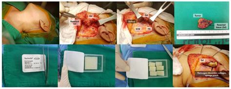 Jcm Free Full Text Effectiveness Of The Fibrinogen Thrombin