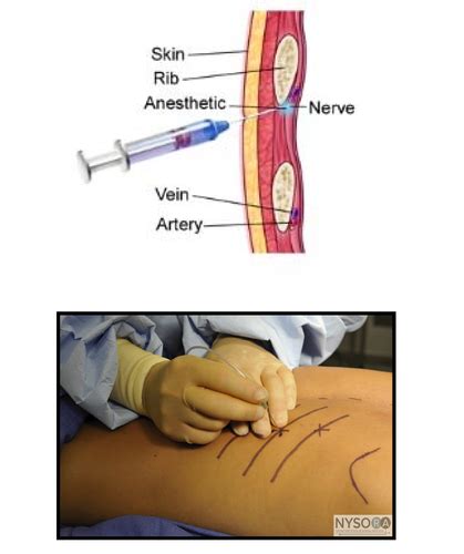 Local Anesthesia Flashcards Quizlet
