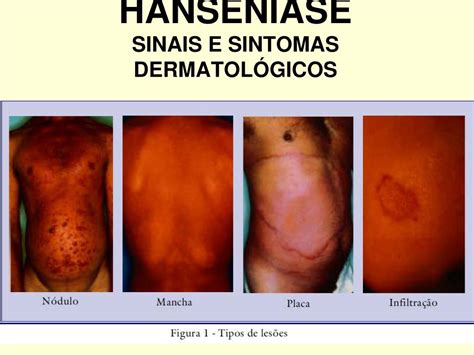 Sinais E Sintomas Da Hanseníase Sdyem