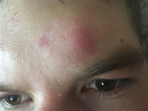 Шишка на лбу что делать Муж на юге загарал без головного убора сначала Medaboutme