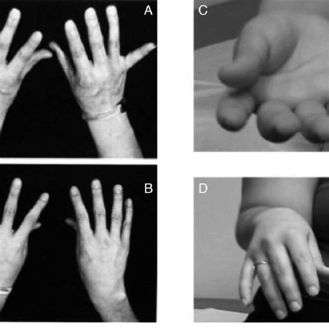 Paroxysmal Motor Disorder Diagnostic Algorithm I Seizures Should Be