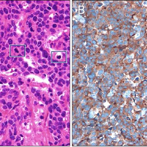 Endoscopic Retrograde Cholangiogram Reveals Malignant Stricture Of The
