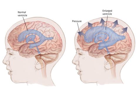 Neural Alterations Flashcards Quizlet