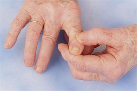 Pin On Osteoarthritis