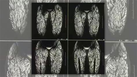 Image Shows Woman Riddled With Internal Parasites From Eating Raw Pork