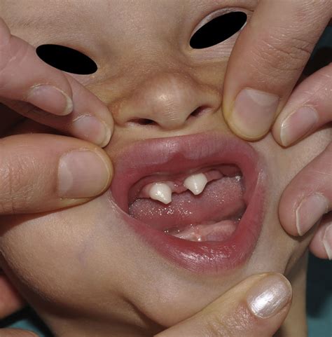Ectodermal Dysplasia Syndrome Related Healthjournals Ectodermal Ectodermal Dysplasia Syndrome Related Healthjournals Ectodermal