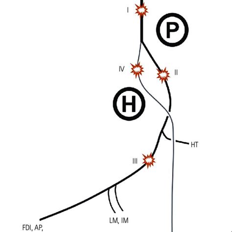 Classification Of Ulnar Neuropathy At The Wrist And Hand According To