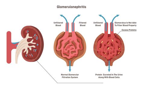Treatment Of Glomerular Diseases In Turkey Nephrology Care