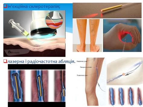 Варикозна хвороба Сучасний стан проблеми презентация онлайн