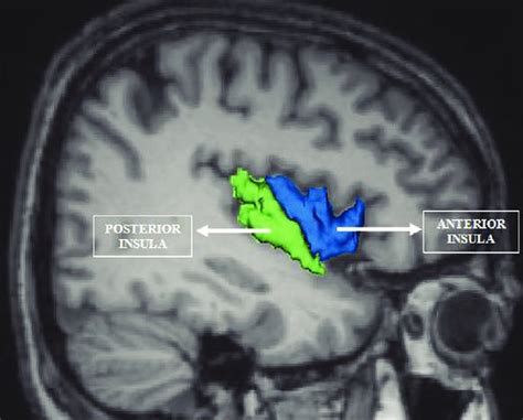 insular cortex mri