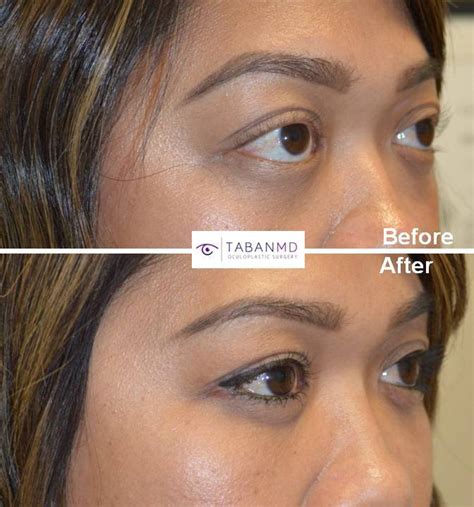 How To Do Makeup For Bulging Eyes Saubhaya Makeup