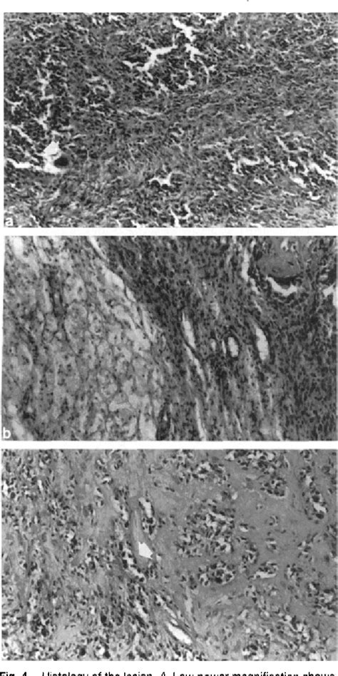 Figure 1 From Extra Articular Localized Nodular Synovitis Giant Cell Tumor Of Tendon Sheath