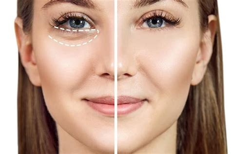 درمان قطعی پف زیر چشم با 10 روش موثر مرکز زیبایی الف