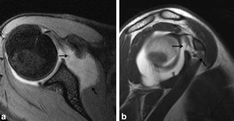 Subscapularis Recess Axial Fat Saturated T1 A And Oblique Sagittal