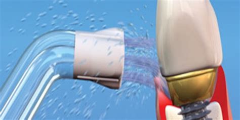 Cleaning Of Dental Implants Dentalimplantindia