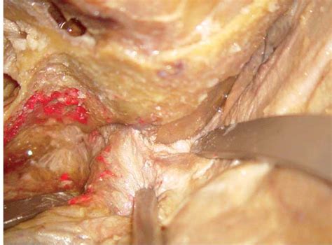 9 Frontotemporal Orbitozygomatic Transcavernous Approach Neupsy Key