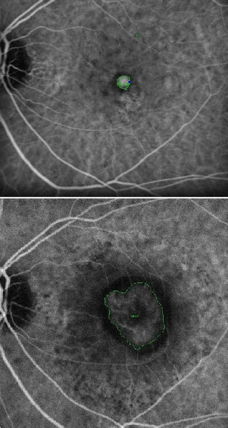 Choroidal Neovascularization With Indocyanine Green Angiography In Download Scientific Diagram