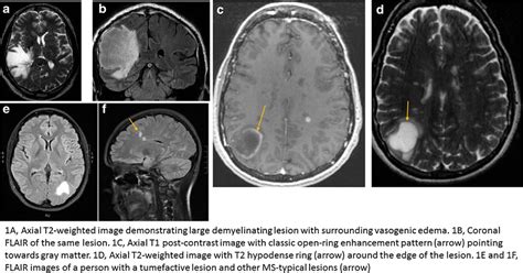 Common Mri Features Of Tumefactive Demyelinating Lesions A Axial