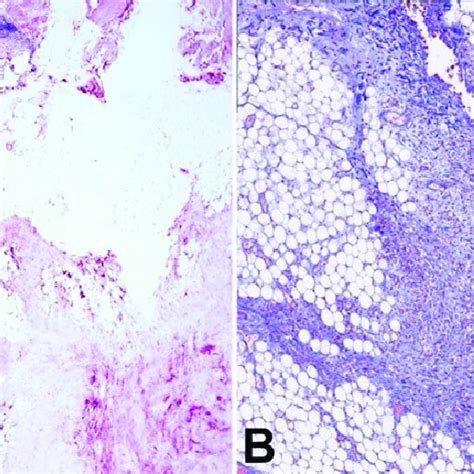 Microphotograph Of A 1 5cm Mesenteric Distant Mass That Exhibits The Download Scientific