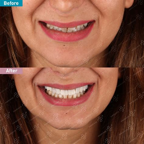 Dental Implants Turkey Individual Full Mouth And All On 4 Medaway
