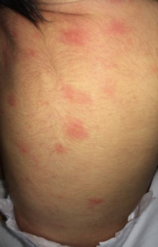 Set 2 Dermatology 2nd Flashcards Quizlet