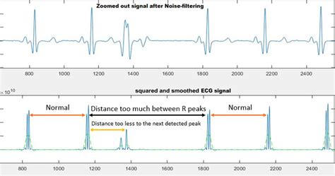 Irregular Beat Occurrences Leading To Arrhythmic Heart Beats