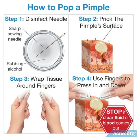 Popped Pimple Diagram