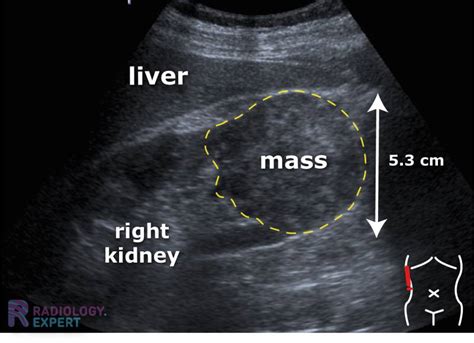 Abdominal Ultrasound