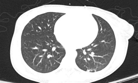 Ludwigs Angina Anterior Neck Abscess And Cavernous Venous Thrombosis