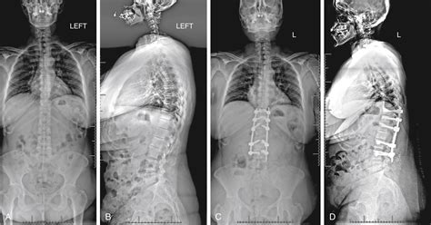 Anterior And Lateral Approaches To The Thoracic Spine Clinical Tree