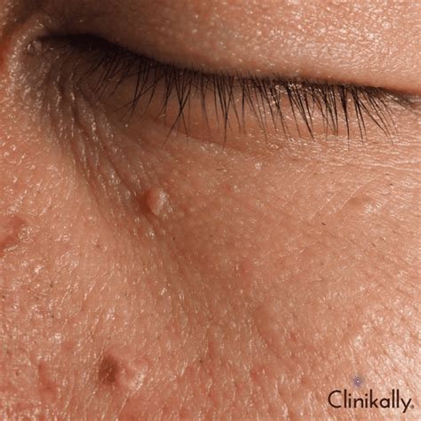 Skincare Routine For Rough And Bumpy Skin Clinikally