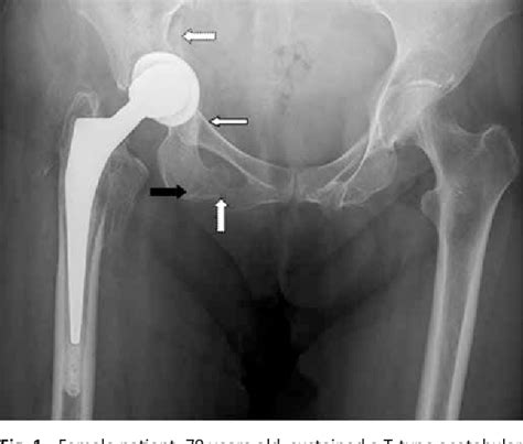 Figure 1 From Management Of Pelvic Discontinuity In Revision Total Hip Arthroplasty A Review Of