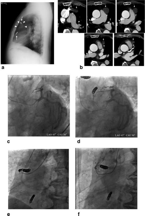Imaging Findings After The Catheter Intervention A Chest X Ray Download Scientific Diagram