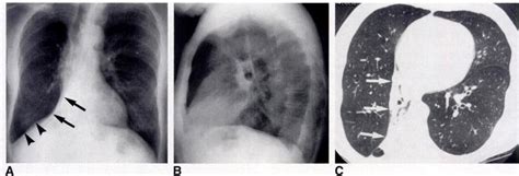 Complete Combined Atelectasis Of Middle And Lower Lobes Of Right Lung