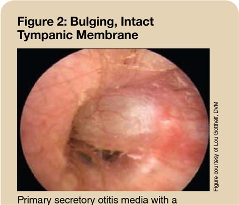 Figure 1 From The Challenges Of Otitis Media Semantic Scholar