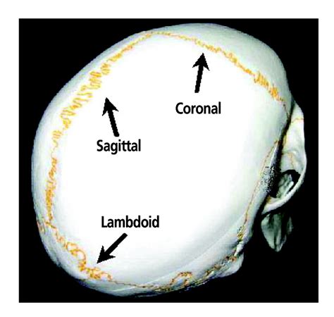 Sagittal Suture