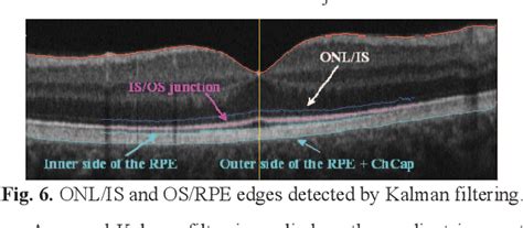 figure 6 from automated segmentation of retinal layers in oct imaging