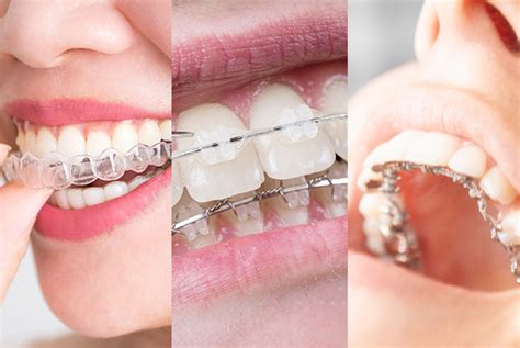 Invisalign Braces What Makes Invisalign Different From Braces