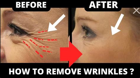 How To Get Rid Of Crows Feet With Face Yoga Facial Exercises For