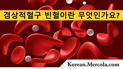 유전형이 있는 겸상 적혈구 빈혈 혈통