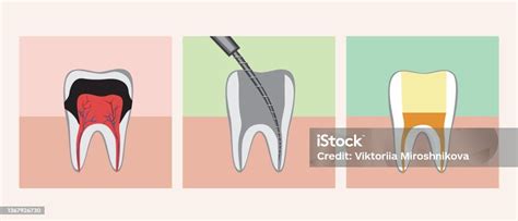 Tooth Pulpitis Treatment Process Flat Vector Stock Illustration Collage Or Banner Set With Molar