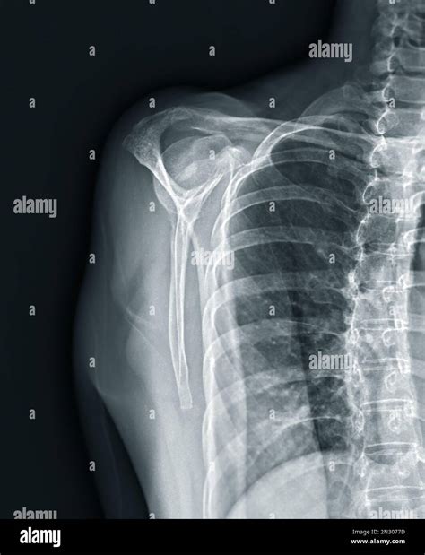 X Ray Shoulder Joint Shoulder Transcapular View For Diagnosis Fracture