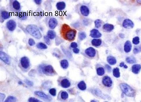 Ebv Lytic Phase Was Limited To A Few Scatter Plasma Cells In The