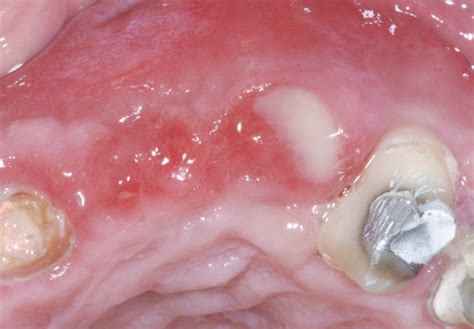 Complications In Bone‐grafting Procedures Classification And