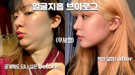 얼굴 지방흡입 브이로그 일주일에서 다섯달차 후기까지 Youtube