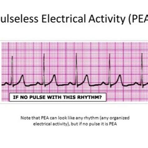 Stream Pulseless Electrical Activity Pdf Free Fixed By Yeudabuchtb