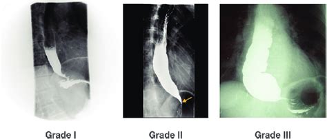 Upper Gastrointestinal Series Showing The Grade Classification Grade I