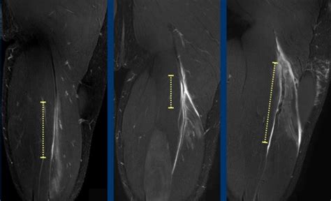 Pulled Hamstring Mri