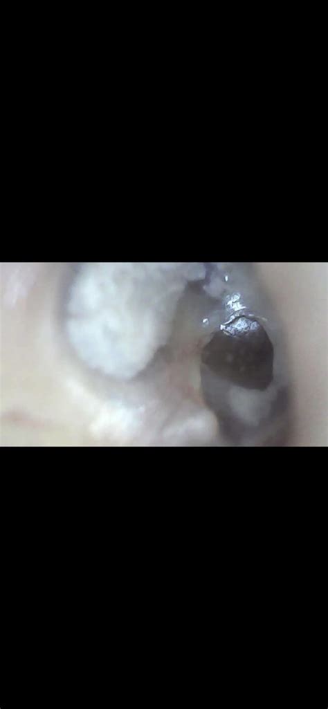 Anyone Elses Eardrum Look Like This R Eardrums