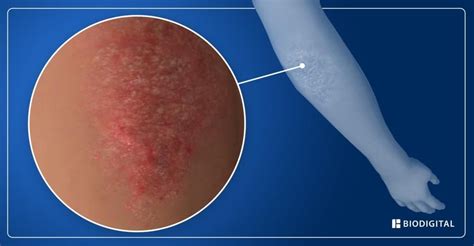 Psoriasis Definisi Penyebab Gejala Hingga Pengobatan